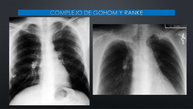 Manifestaciones radiológicas tb pulmonar