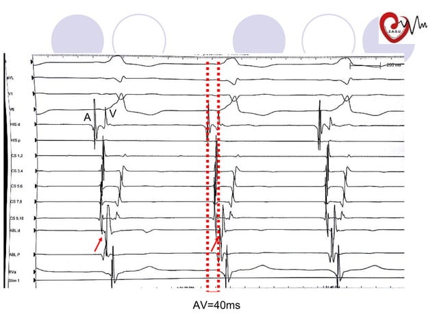 Manifest paraHisian accessory pathway (wpw) ablation our experience | PPT