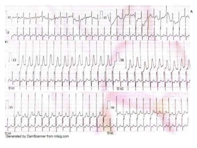 Manifest paraHisian accessory pathway (wpw) ablation our experience