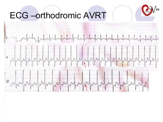 Manifest paraHisian accessory pathway (wpw) ablation our experience