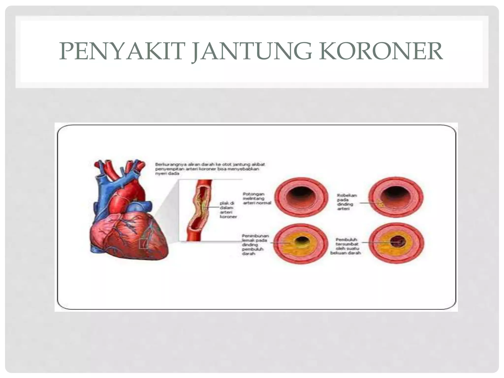 Manifestasi klinis PJK.pptx