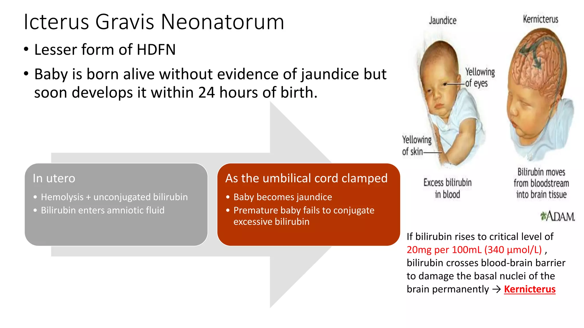 Manifestation of hdfn & prophylaxis of rh isoimmunization | PPTX
