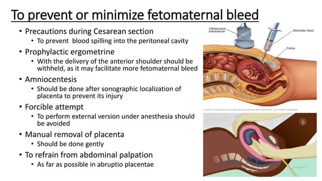 Manifestation of hdfn & prophylaxis of rh isoimmunization | PPT