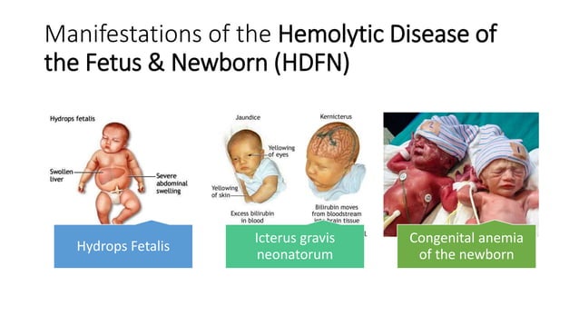 Manifestation of hdfn & prophylaxis of rh isoimmunization | PPT