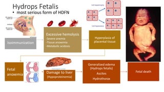 Manifestation of hdfn & prophylaxis of rh isoimmunization | PPTX
