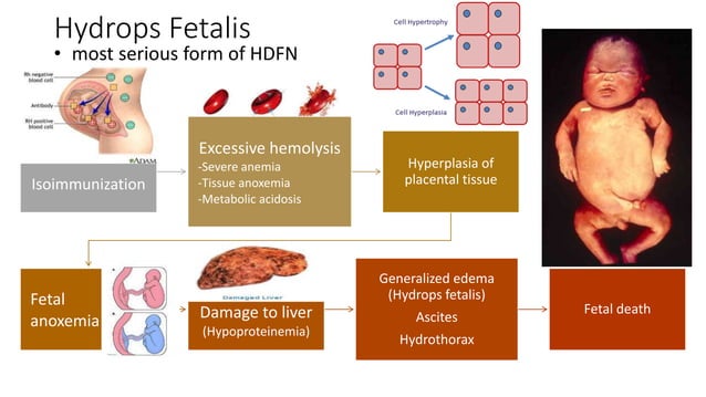 Manifestation of hdfn & prophylaxis of rh isoimmunization | PPT
