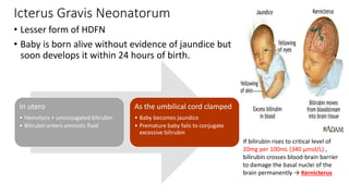 Manifestation of hdfn & prophylaxis of rh isoimmunization | PPTX