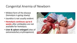 Manifestation of hdfn & prophylaxis of rh isoimmunization | PPTX