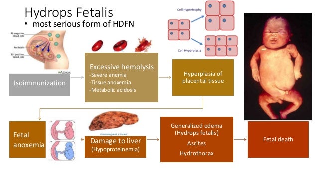 Manifestation of hdfn & prophylaxis of rh isoimmunization