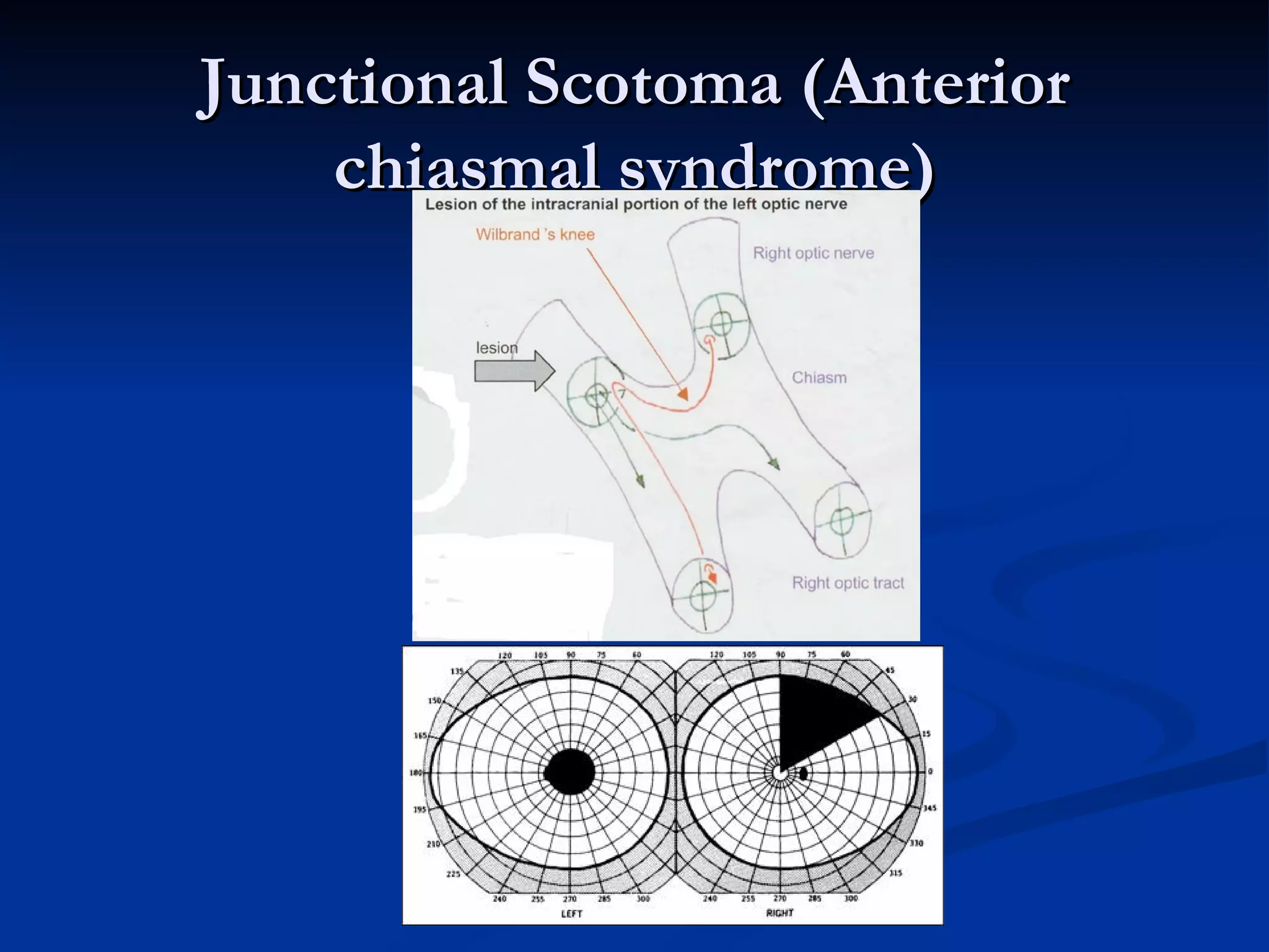 Anatomy and Lesions of Visual Pathways | PPT