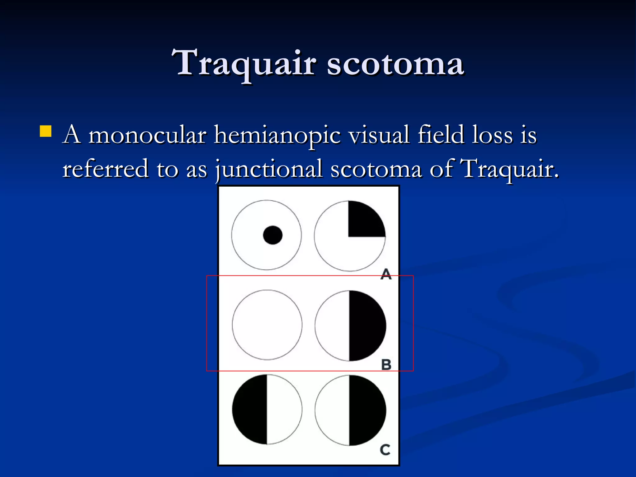 Anatomy and Lesions of Visual Pathways | PPT