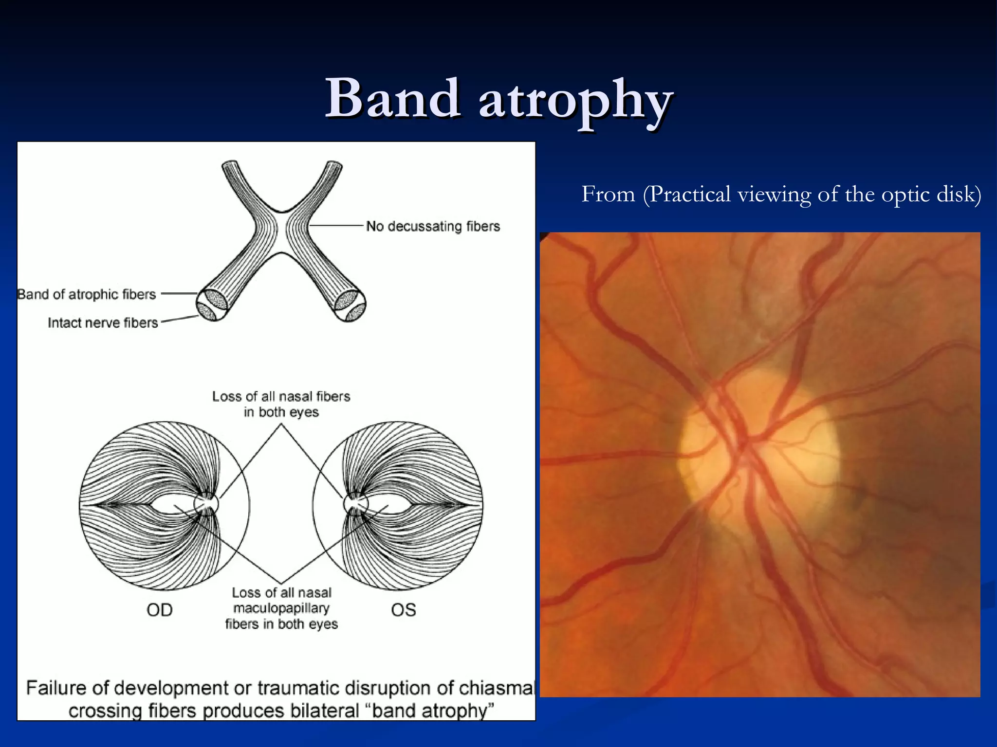 Anatomy and Lesions of Visual Pathways | PPT