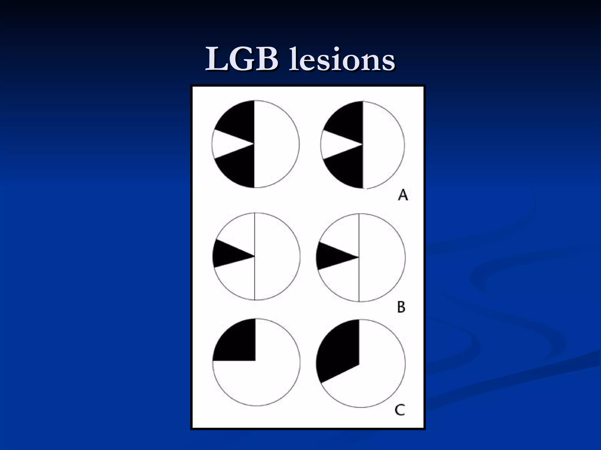 Anatomy and Lesions of Visual Pathways | PPT