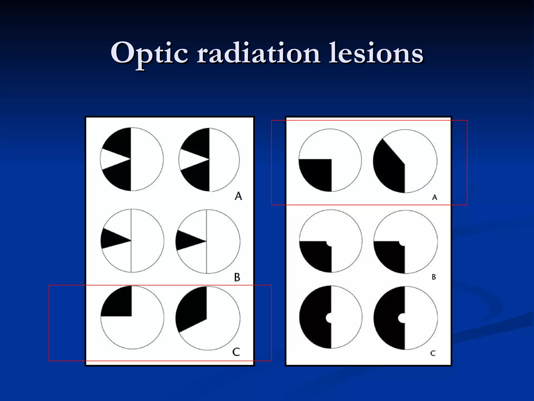 Anatomy and Lesions of Visual Pathways | PPT