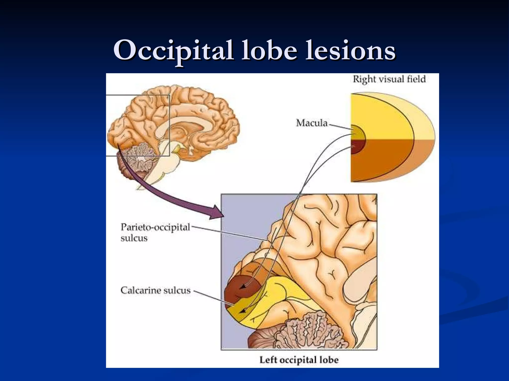 Anatomy and Lesions of Visual Pathways | PPT