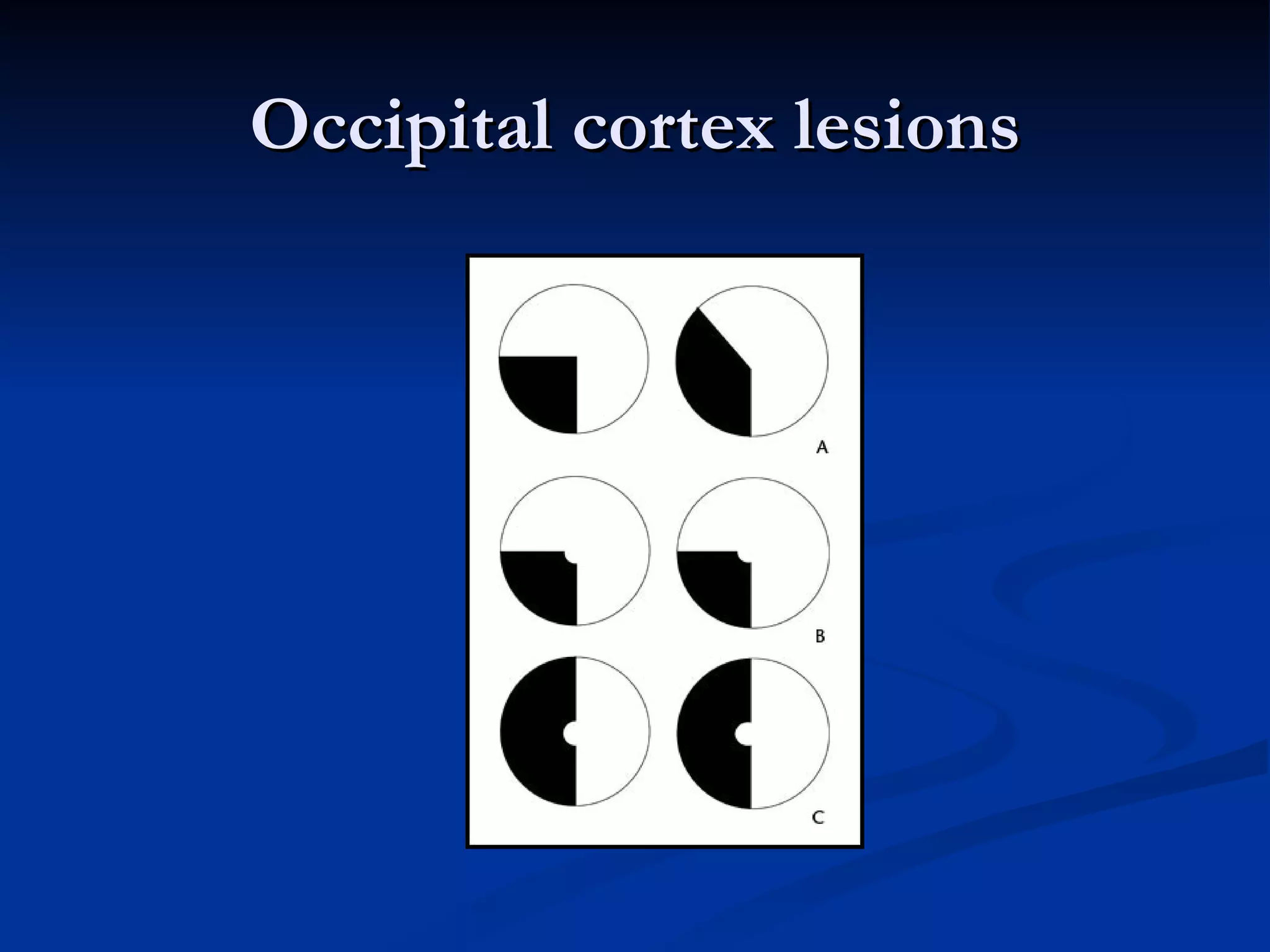 Anatomy and Lesions of Visual Pathways | PPT