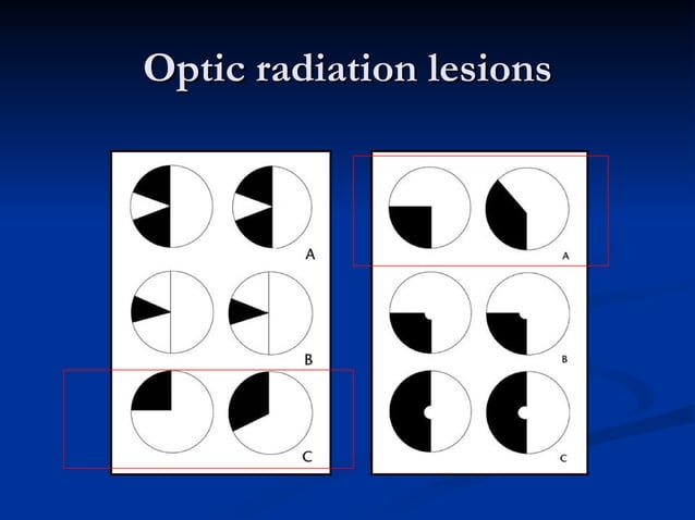 Anatomy and Lesions of Visual Pathways | PPT | Brain and Nervous System ...
