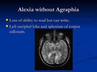 Anatomy and Lesions of Visual Pathways | PPT