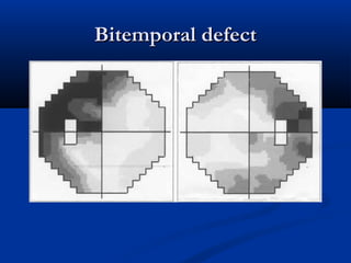 Manifestations of visual pathway lesions | PPT