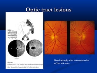 Manifestations of visual pathway lesions | PPT