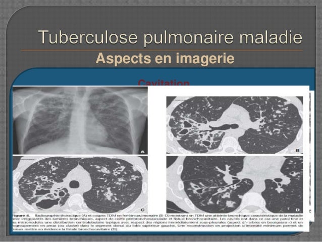 Tuberculose Pulmonaire Signes Cliniques – JCGDPK