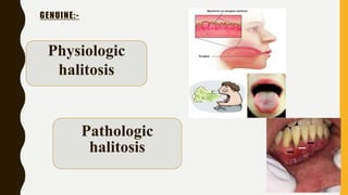 oral malodour/ halitosis | PPTX