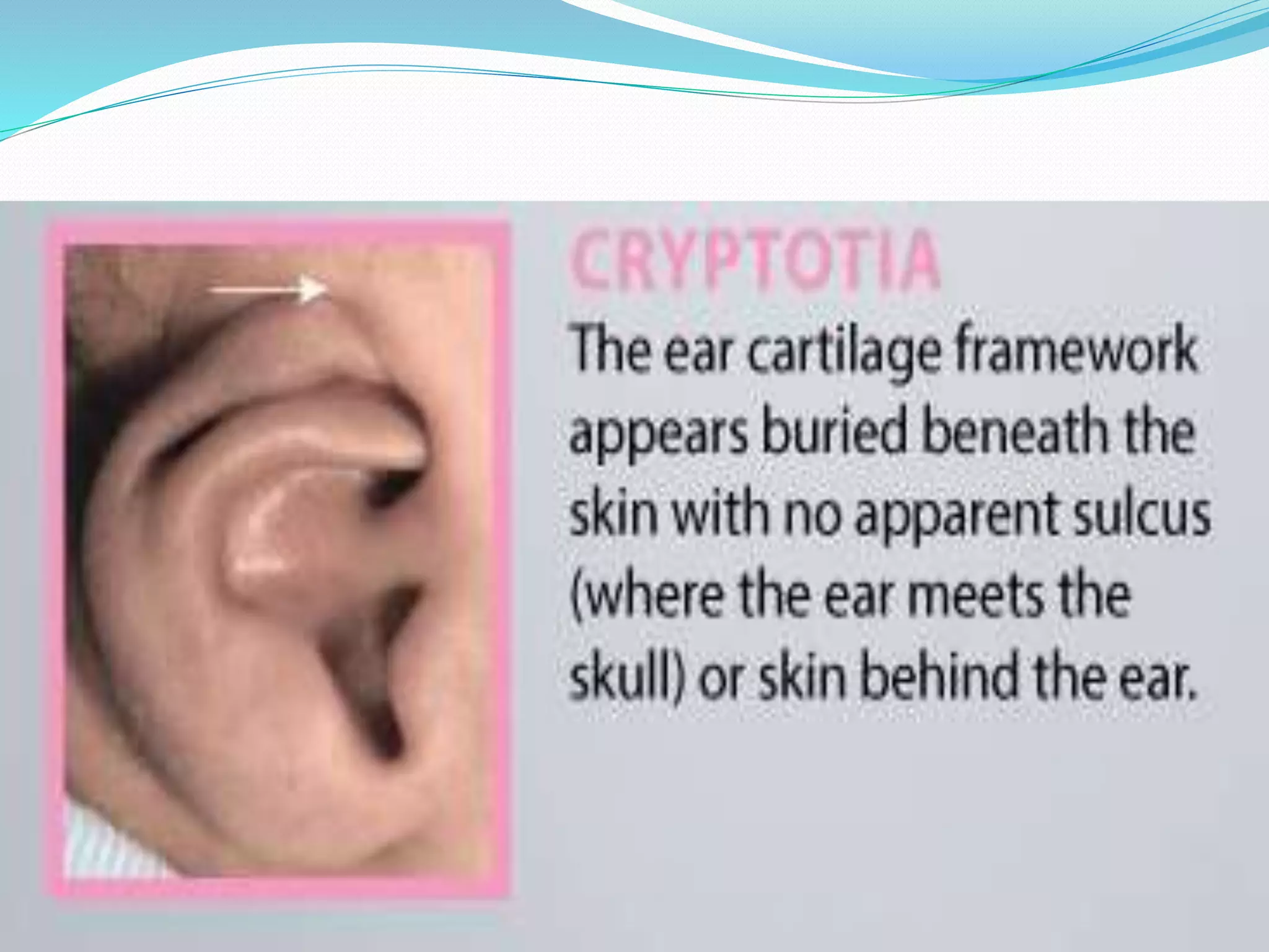 EMBRYOLOGY AND MALFORMATION OF EAR | PPTX