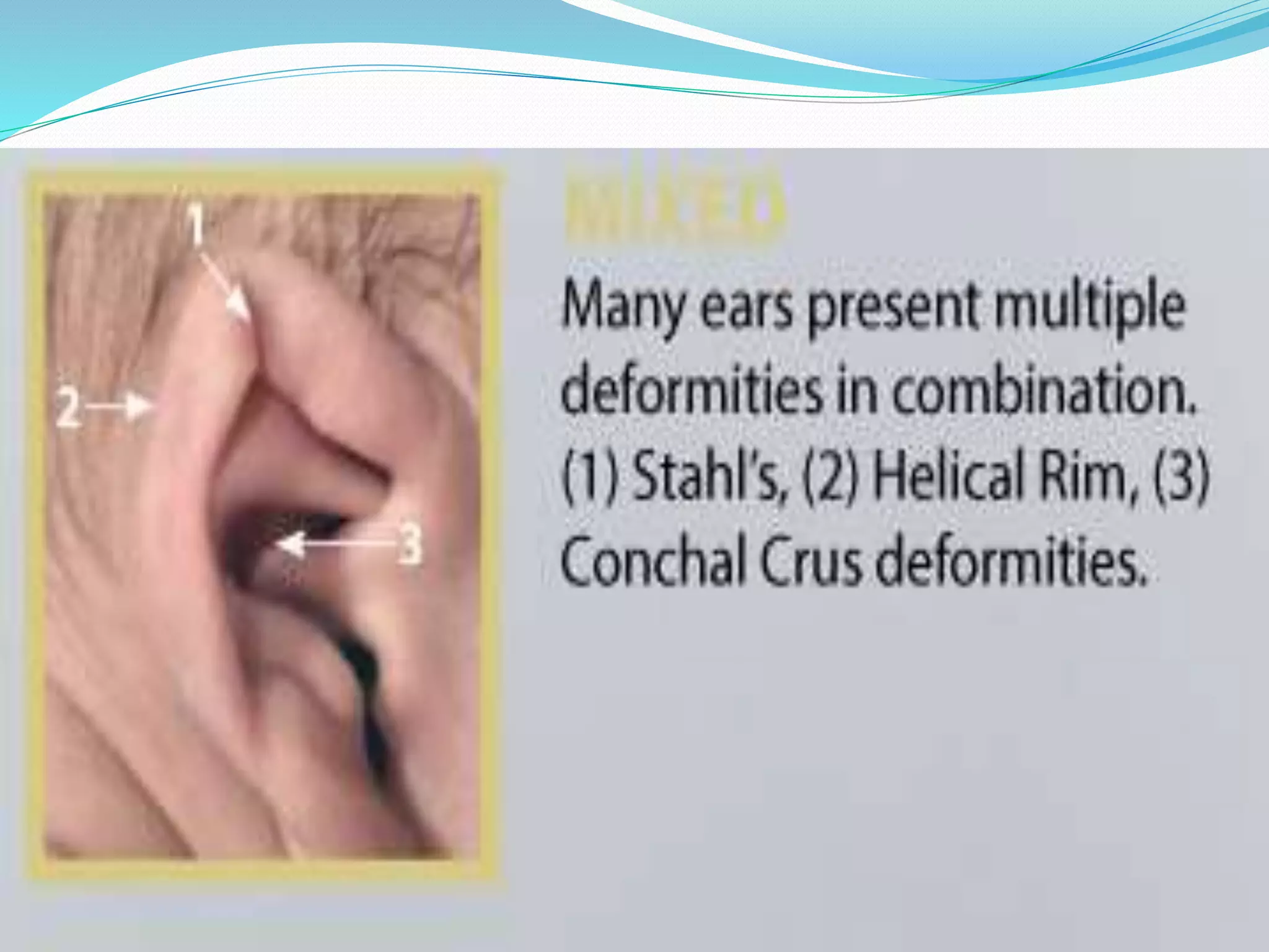 EMBRYOLOGY AND MALFORMATION OF EAR | PPTX