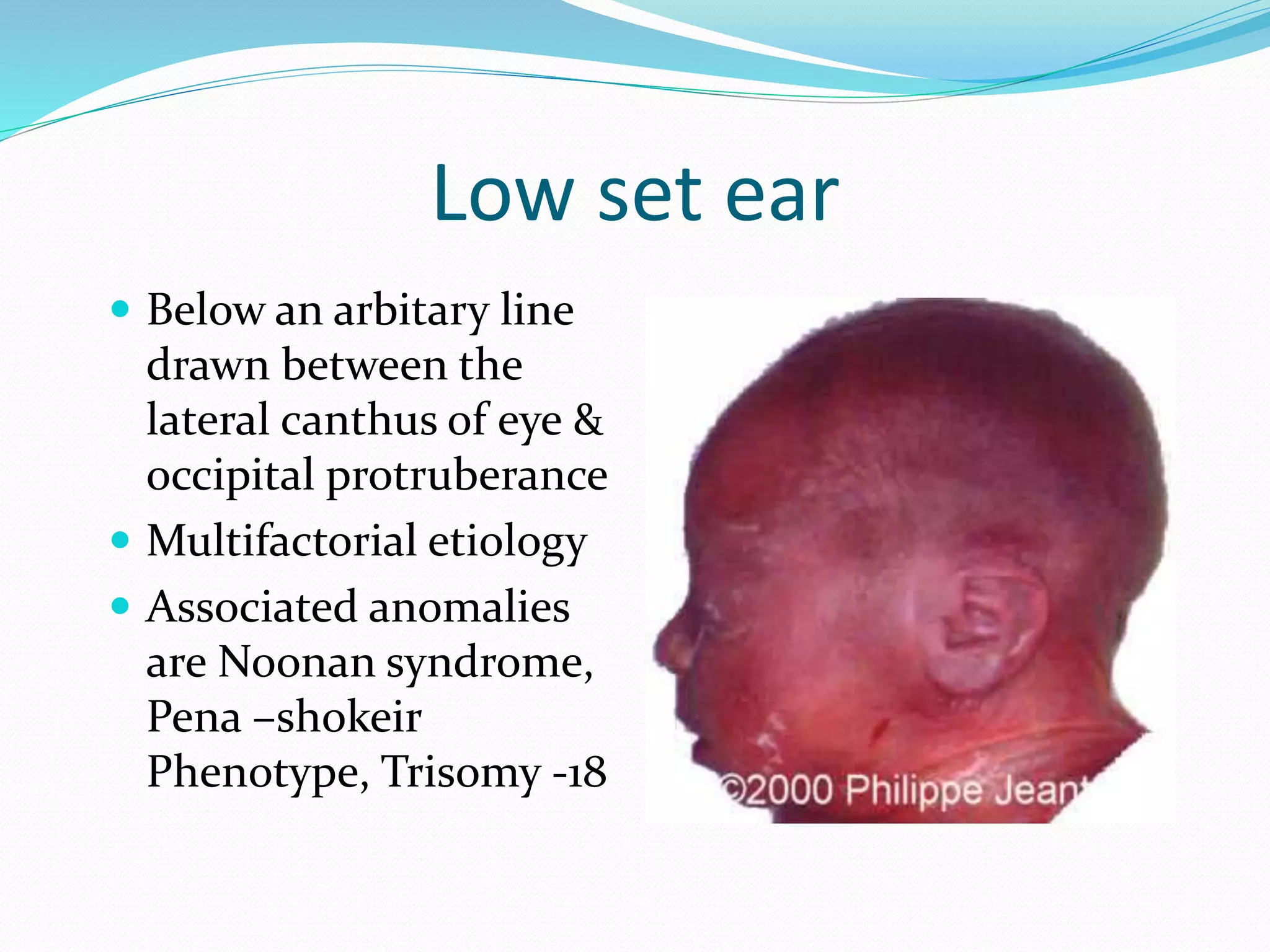 EMBRYOLOGY AND MALFORMATION OF EAR | PPTX