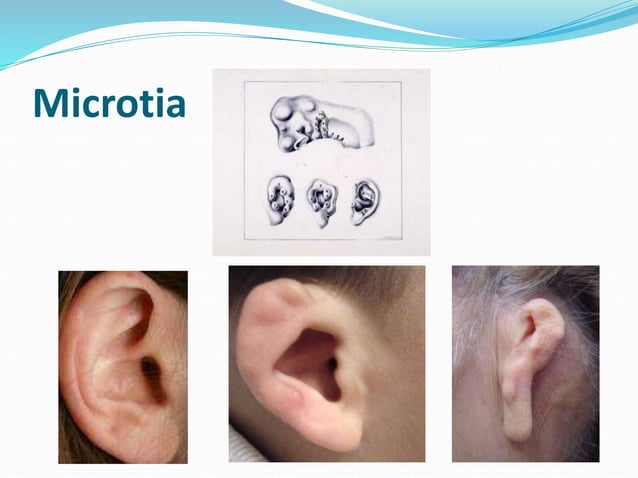 EMBRYOLOGY AND MALFORMATION OF EAR | PPTX