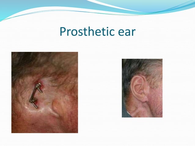 EMBRYOLOGY AND MALFORMATION OF EAR | PPTX