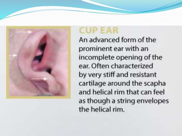 EMBRYOLOGY AND MALFORMATION OF EAR | PPTX