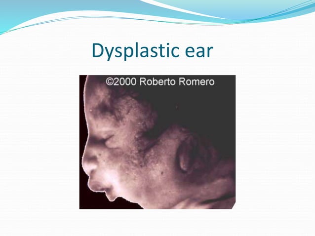 EMBRYOLOGY AND MALFORMATION OF EAR | PPTX