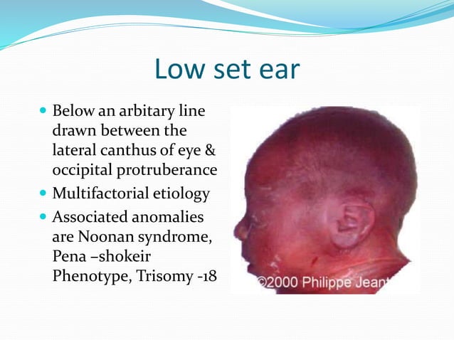 EMBRYOLOGY AND MALFORMATION OF EAR | PPTX