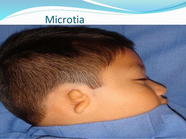 EMBRYOLOGY AND MALFORMATION OF EAR