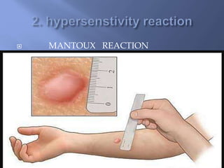Myco.tuberculosis | PPT