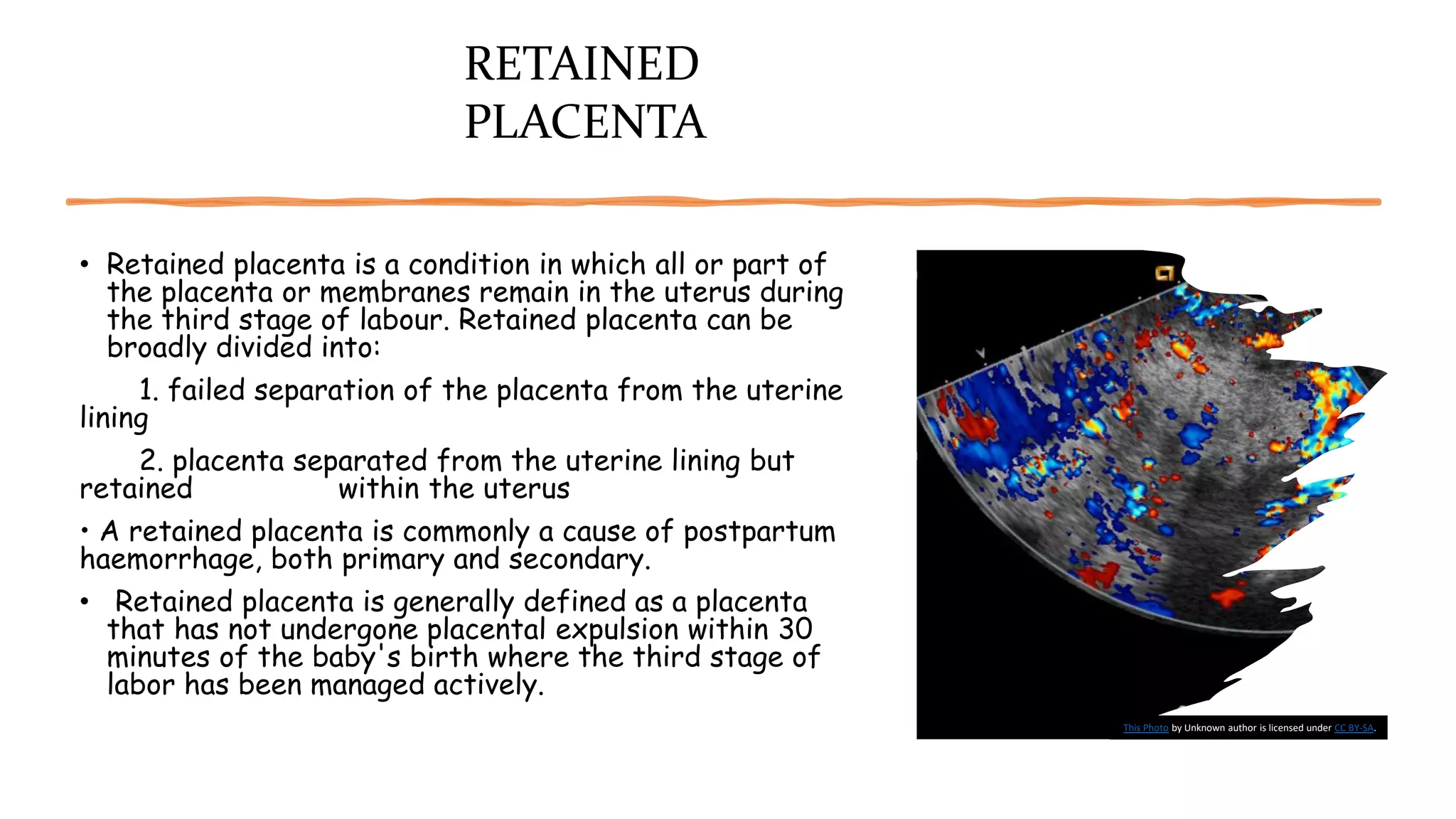 mannual removal of placenta.pptx