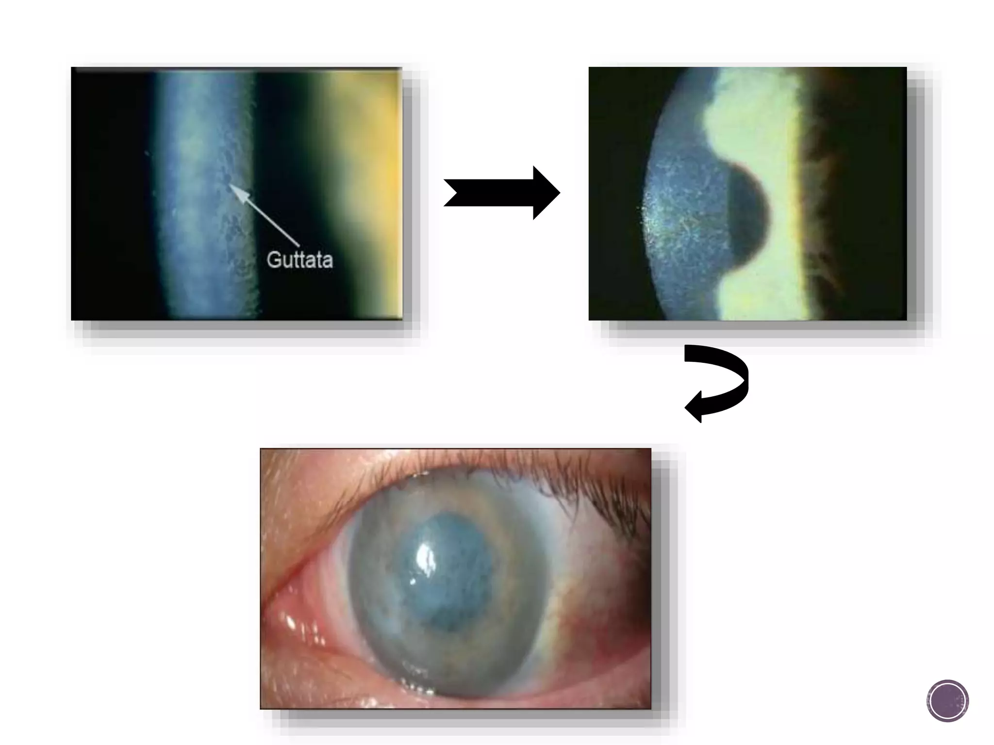 Therapeutic Contact lenses | PPTX