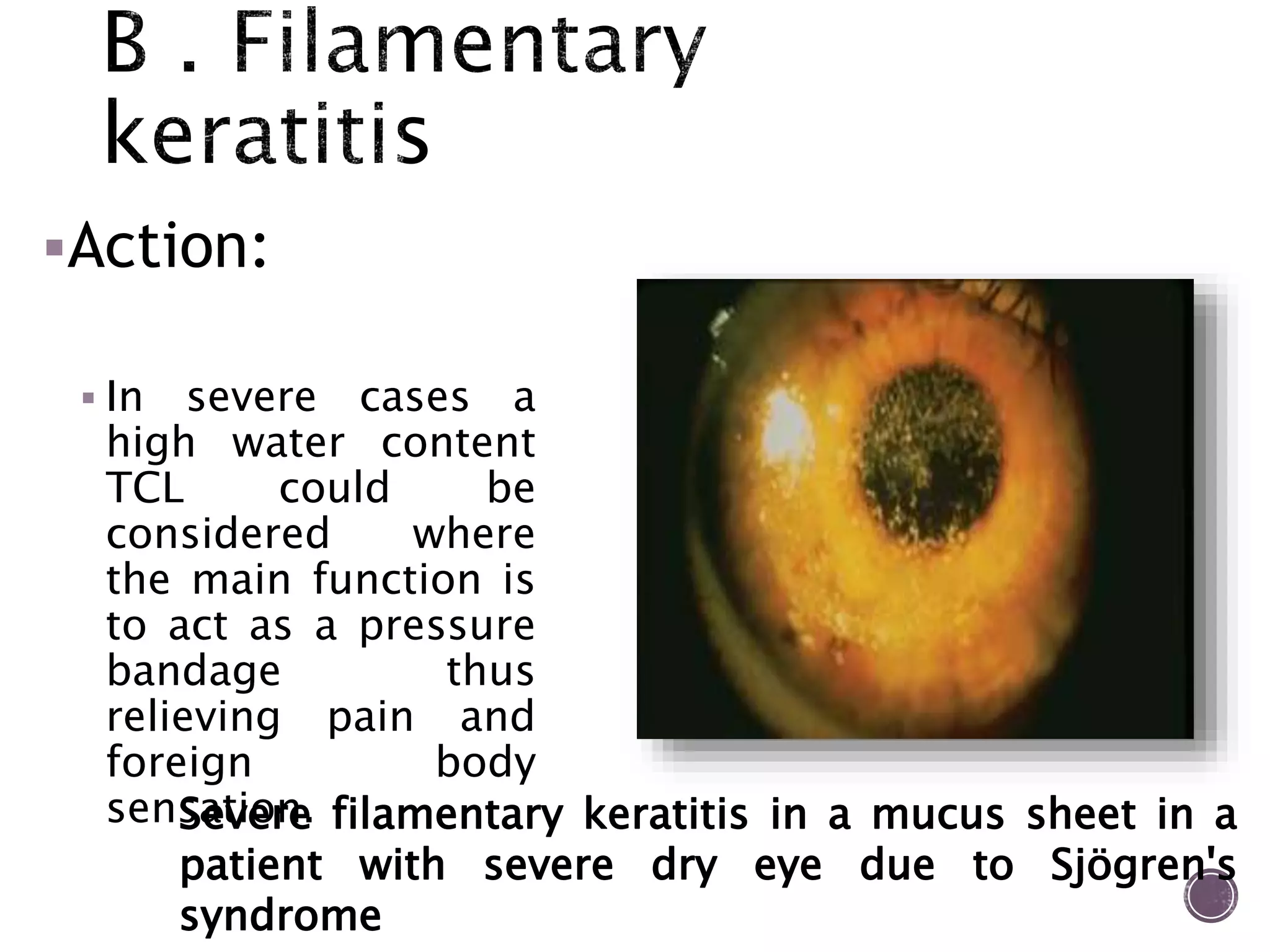 Therapeutic Contact lenses | PPTX