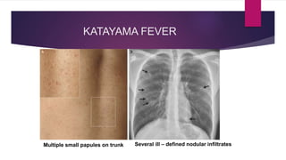 Schistosoma Mansoni and Schistosoma japonicum | PPTX