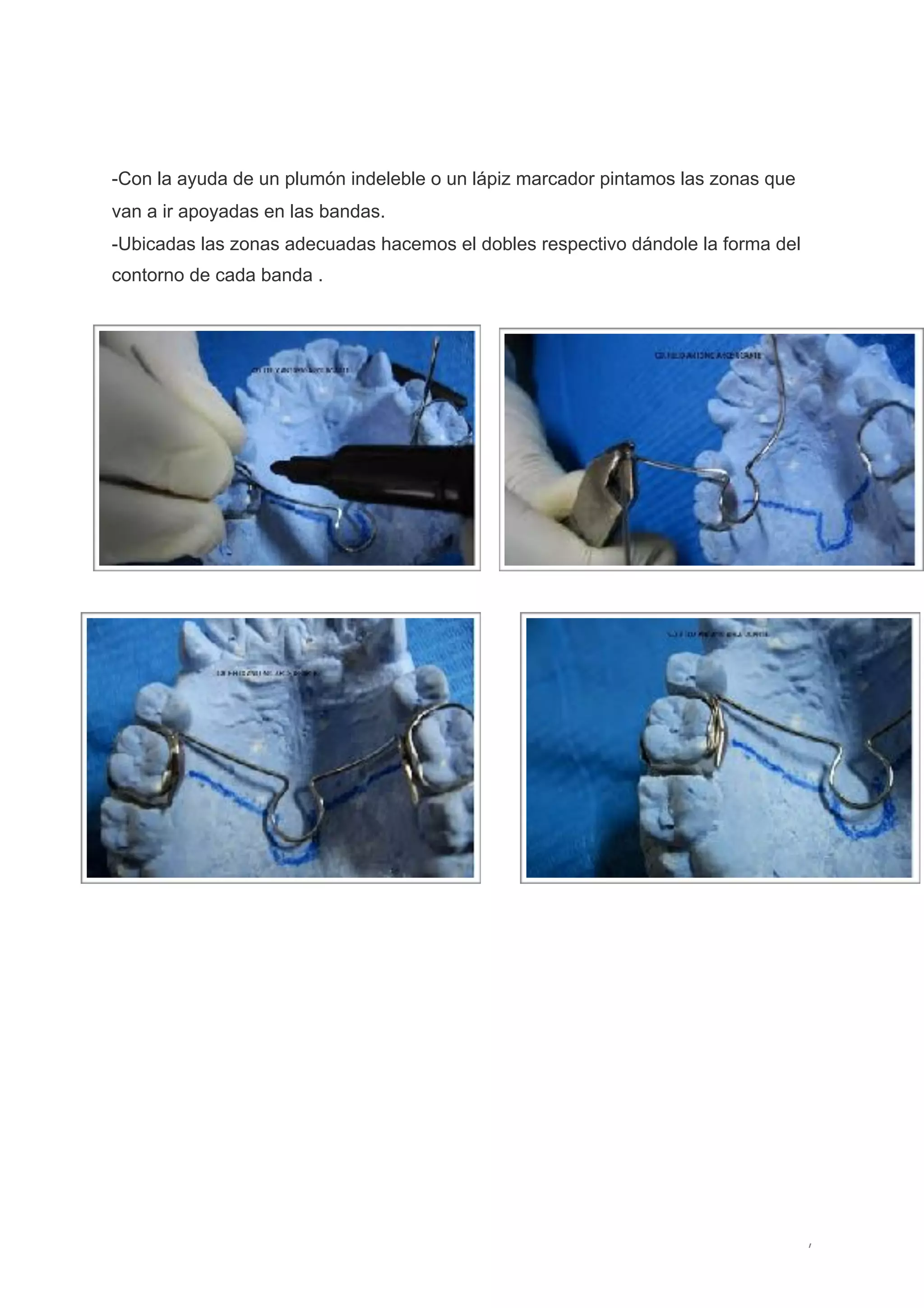 Mantenedores de Espacio odontopediatria | PDF