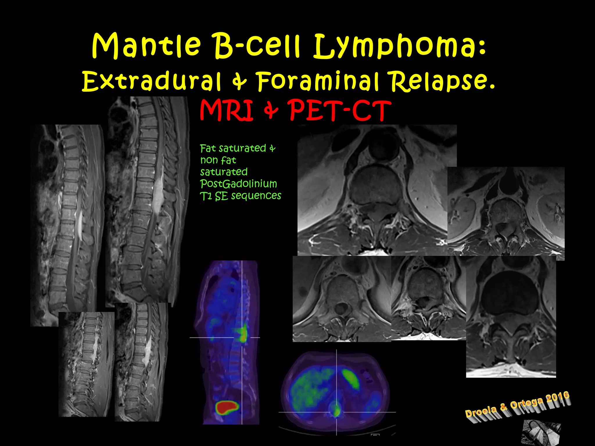 Mantle B-Cell Lymphoma: Extradural & Foraminal Relapse | PPT