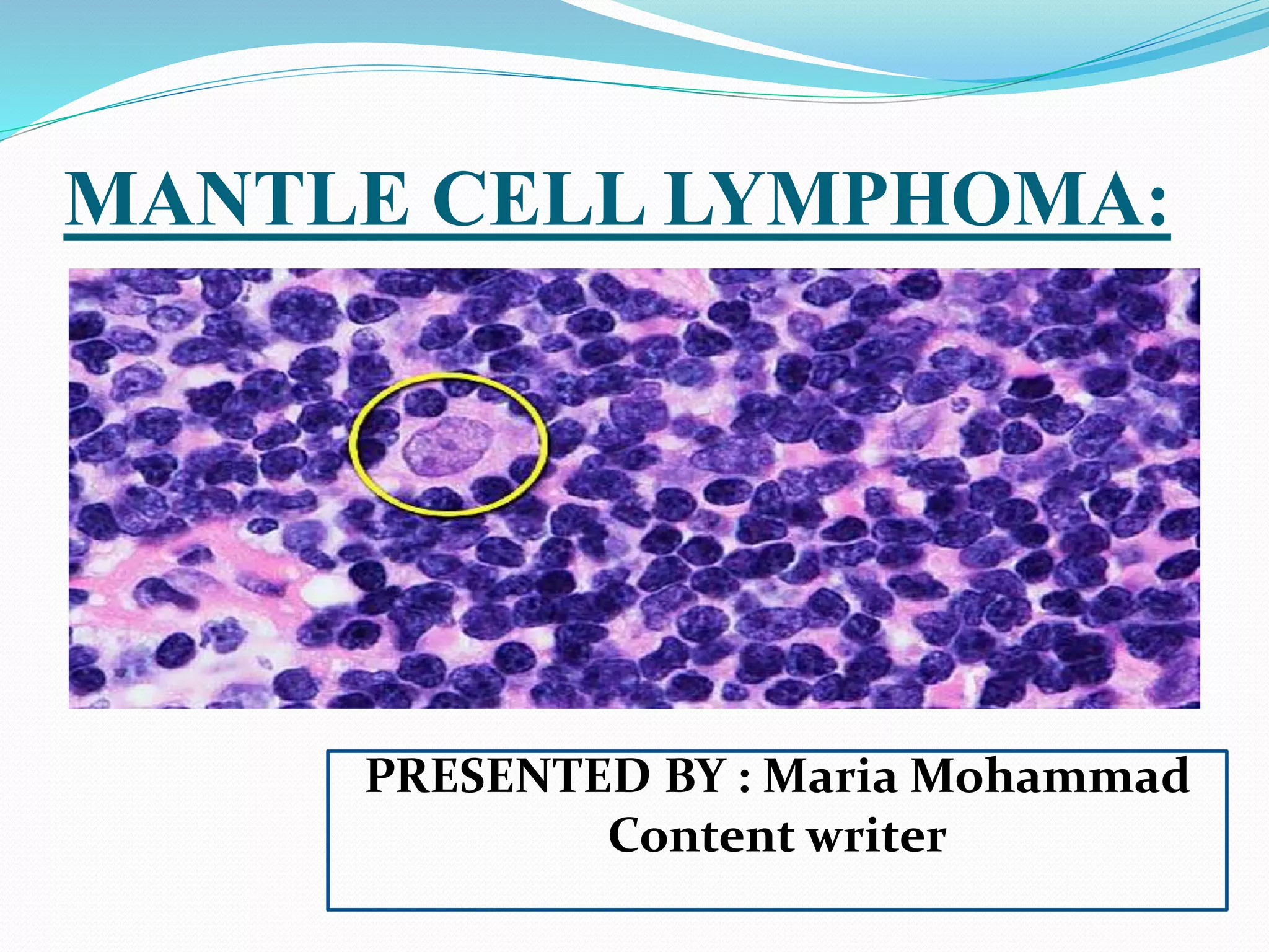 Mantle cell lymphoma | PPTX