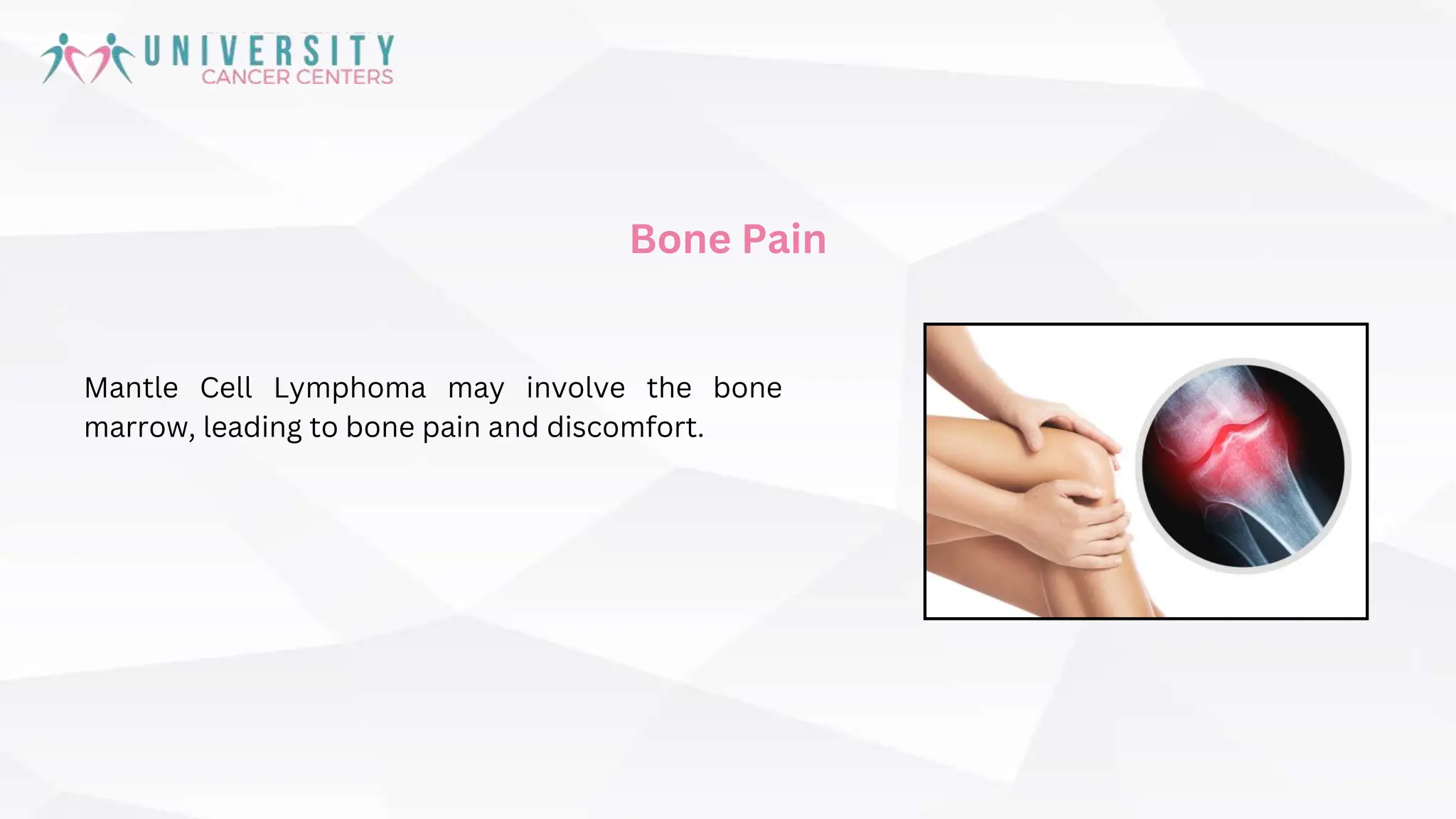 Mantle Cell Lymphoma | PPT