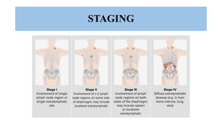 Mantle cell lymphoma overview and management | PPTX