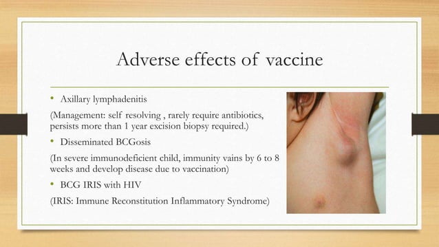 Mantoux, BCG scar-1.pptx | Infectious Diseases | Diseases and Conditions