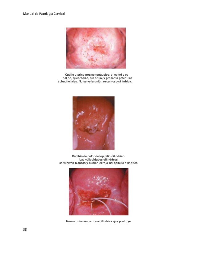 Manual de la clinica de deteccion temprana colposcopia