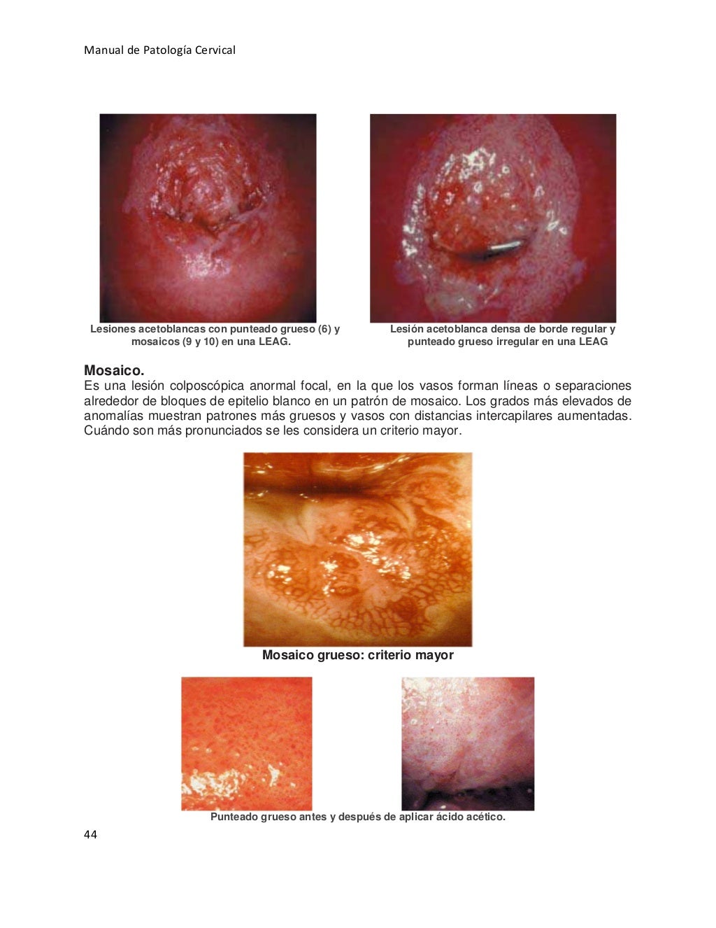 Manual de la clinica de deteccion temprana colposcopia