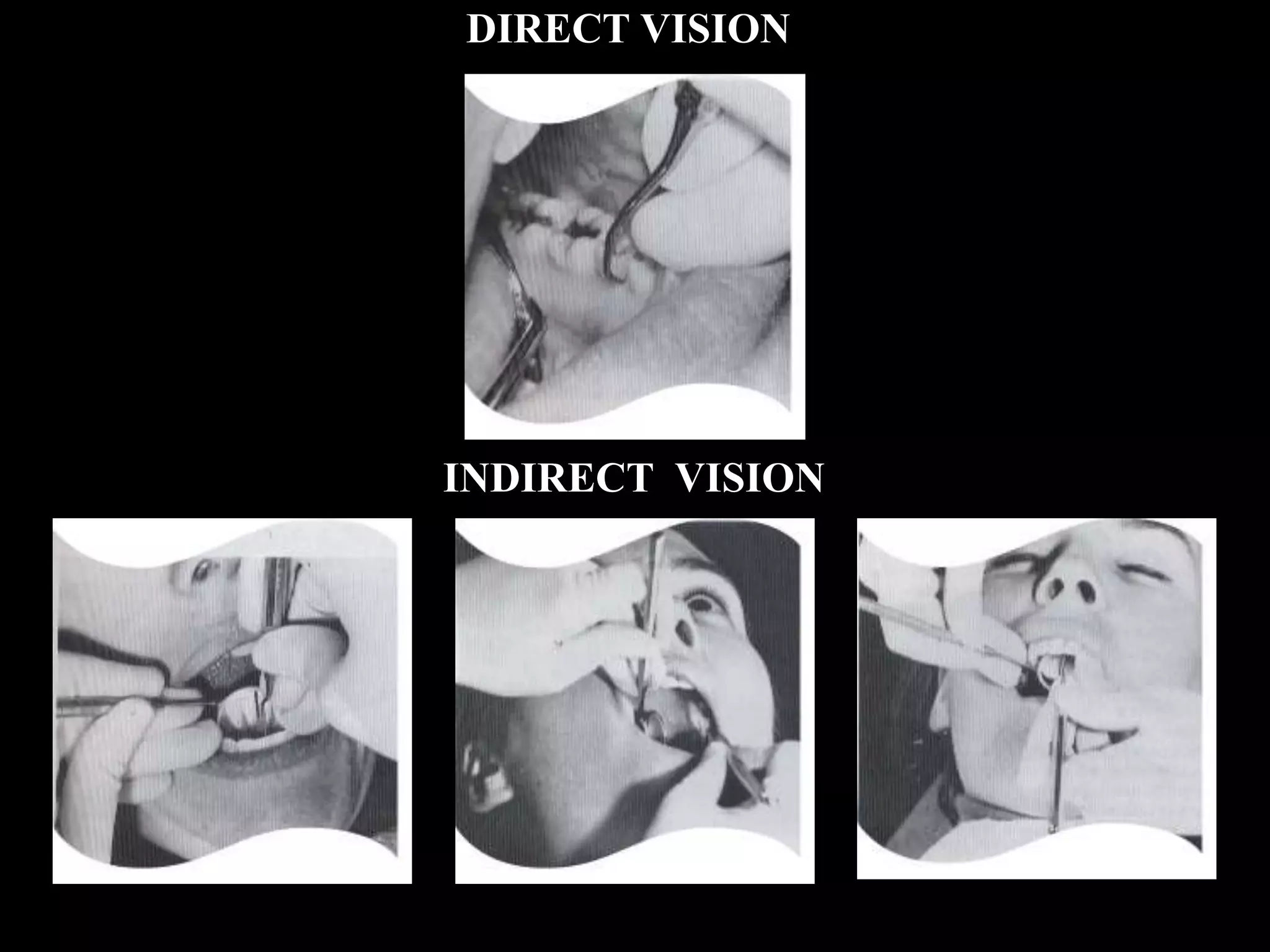 MANUAL INSTRUMENTATION.ppt