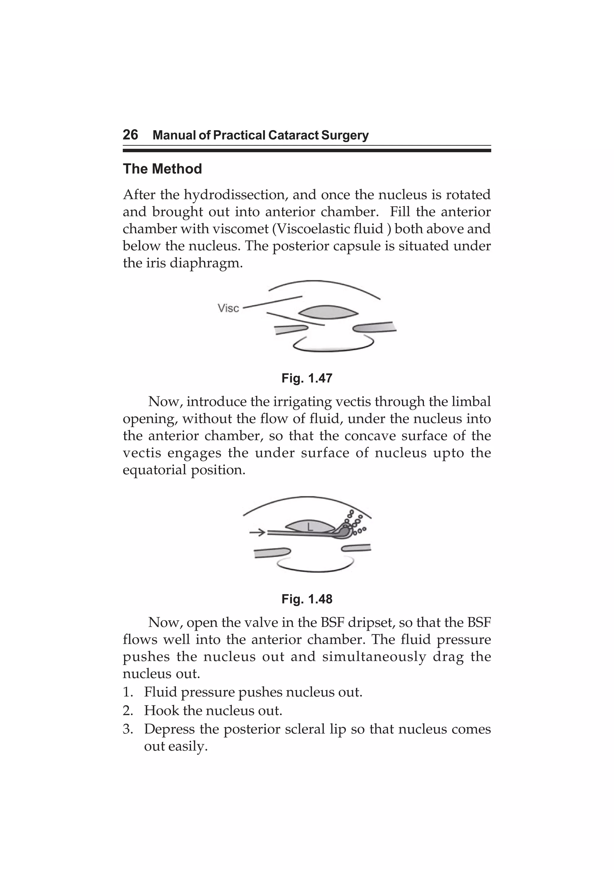 Manual of Practical Cataract Surgery.pdf | Eye and Vision Conditions ...